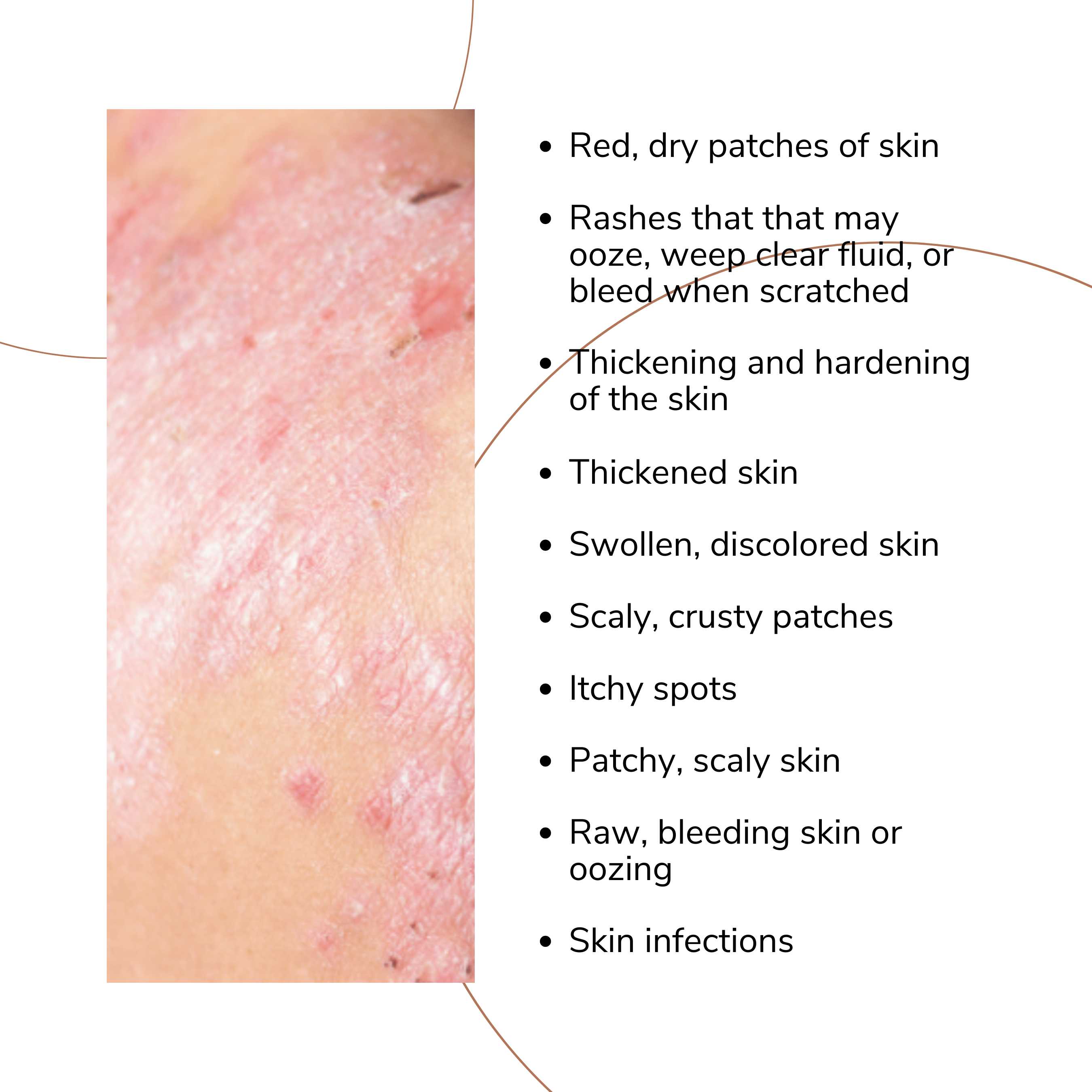 Atopic Dermatitis Eczema Dermtropics